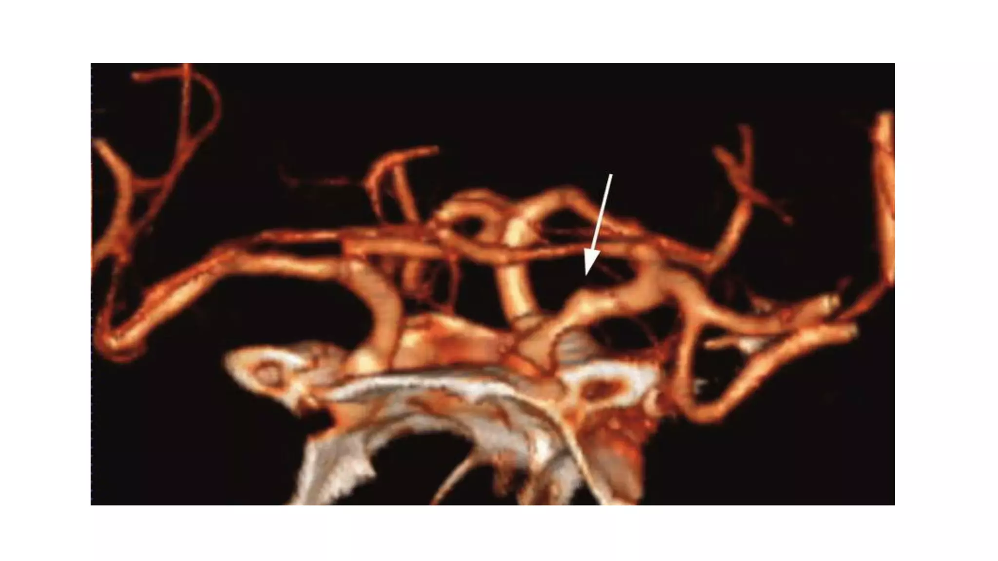 Anterior circulation aneurysm.pptx