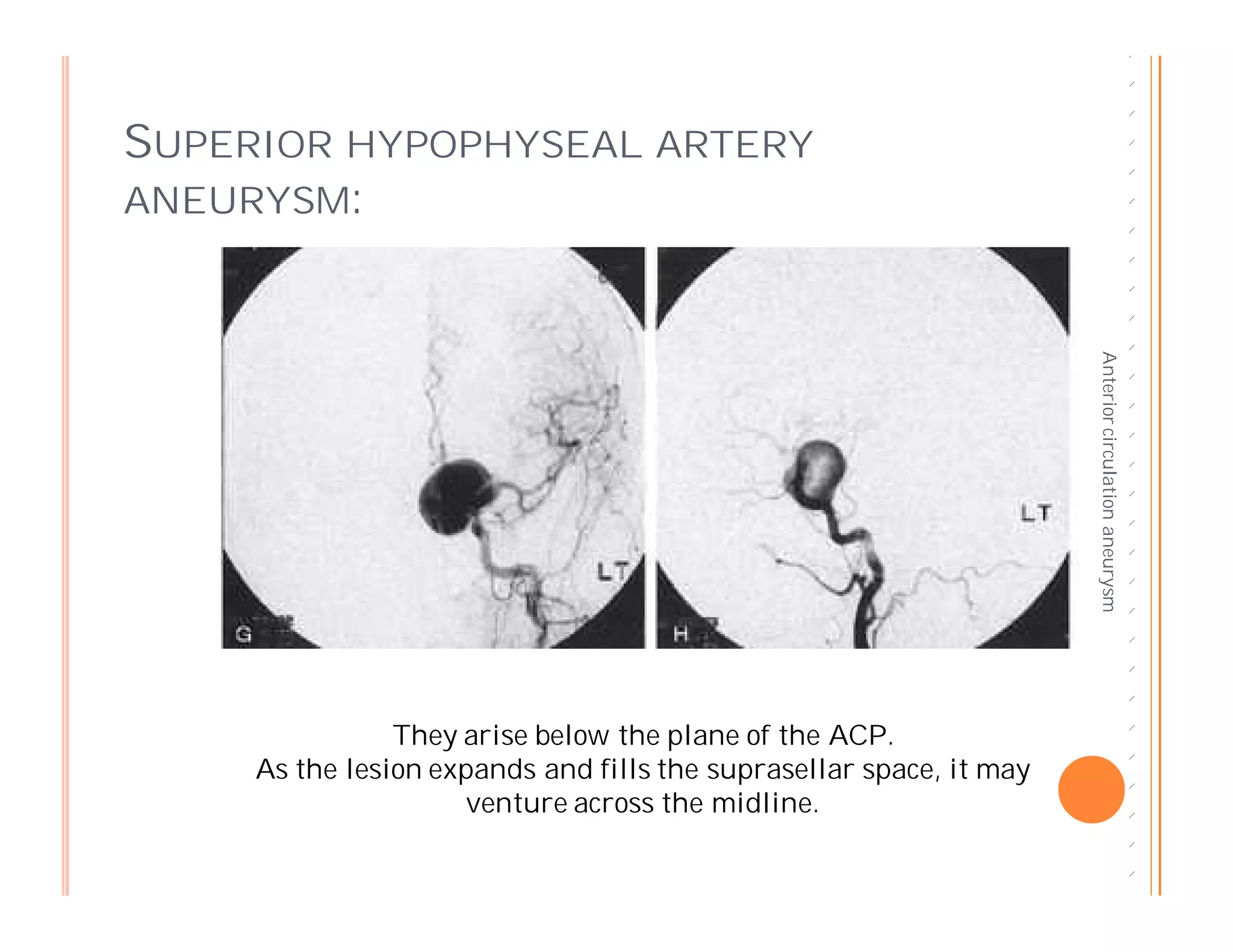 Anterior circulation aneurysms and surgical considerations 2011 | PDF