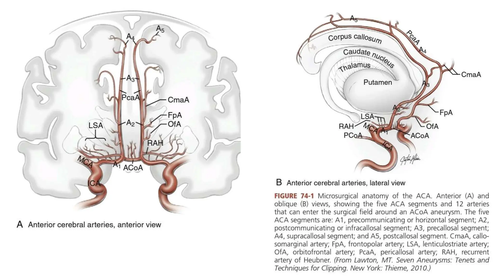 ANTERIOR COMMUNICATING ARTERY ANEURYSMS.pptx