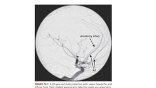 ANTERIOR COMMUNICATING ARTERY ANEURYSMS.pptx