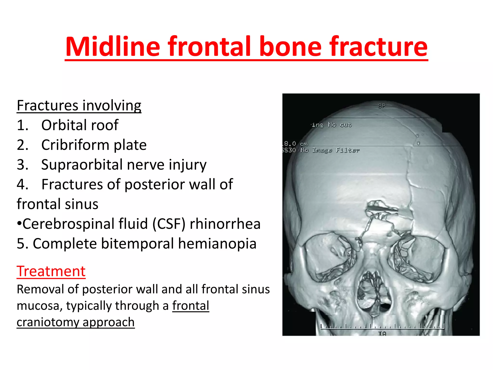 anterior cranial fossa.pptx
