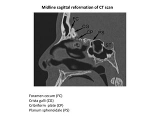anterior cranial fossa.pptx
