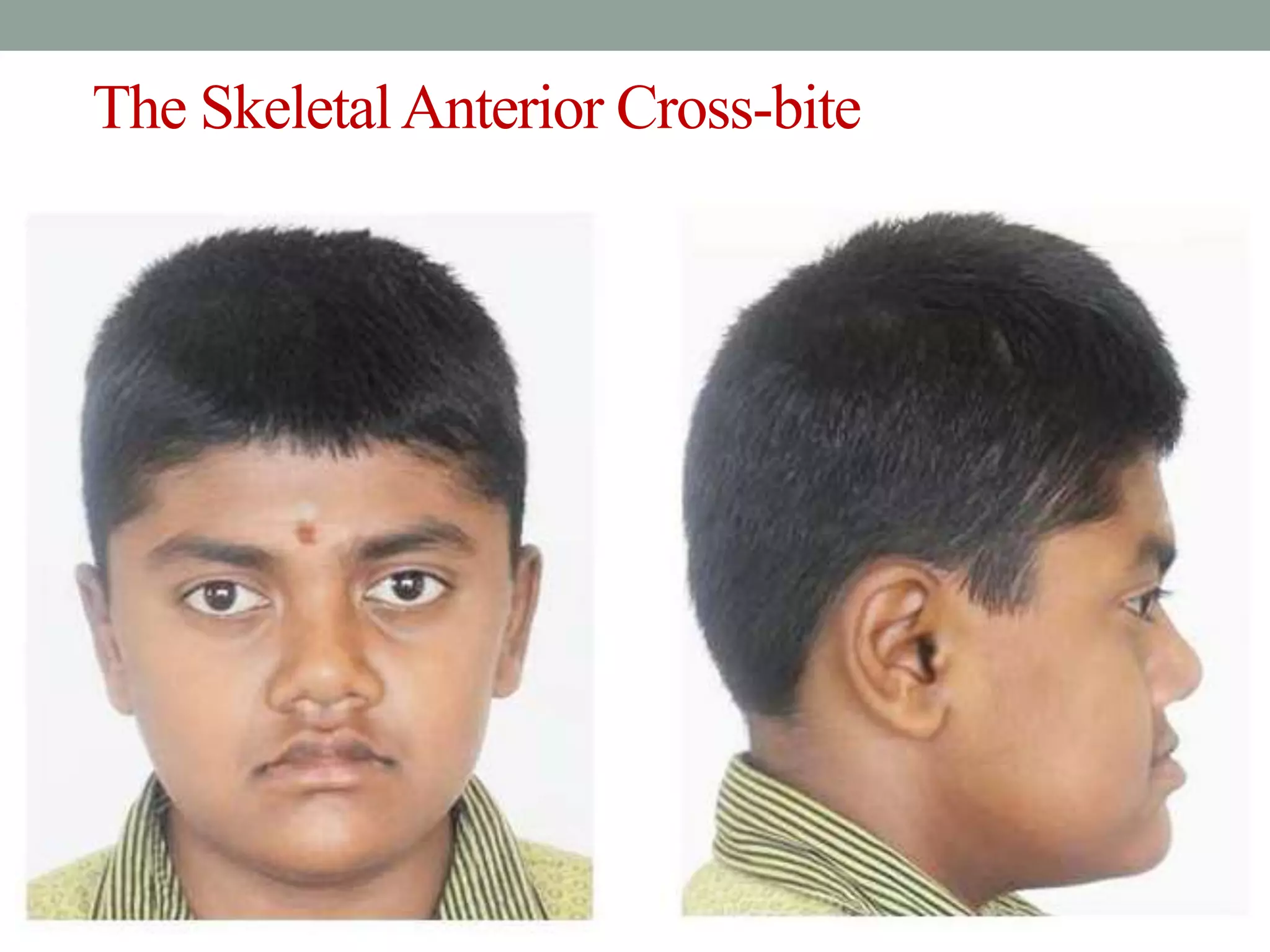 Anterior crossbite | PPTX
