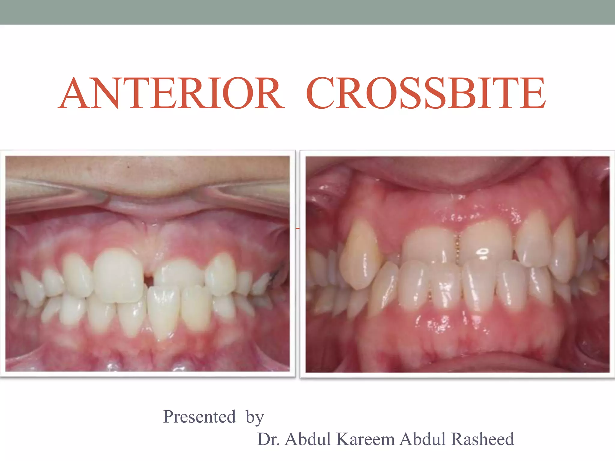 Anterior crossbite | PPTX