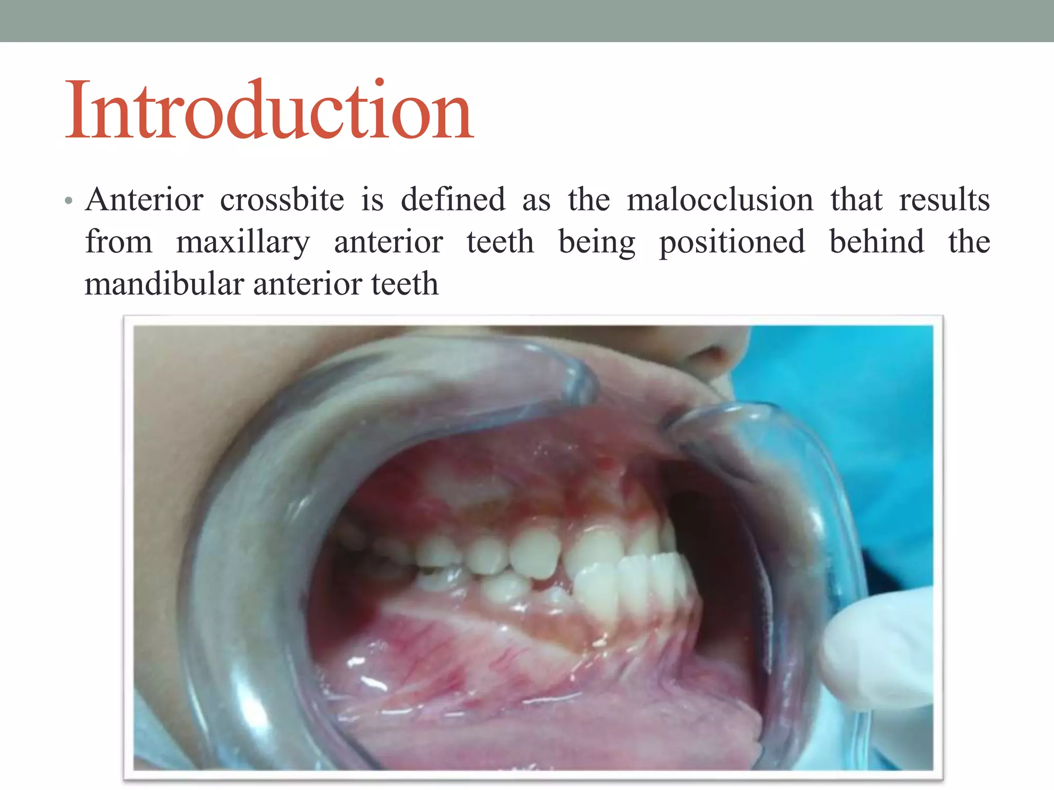 Anterior crossbite | PPTX