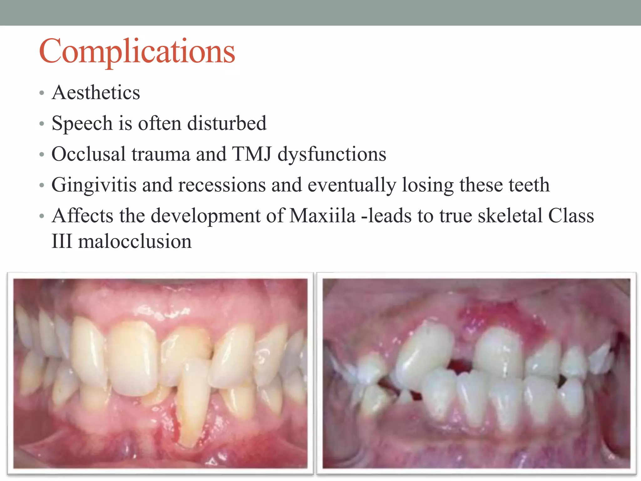 Anterior crossbite | PPTX