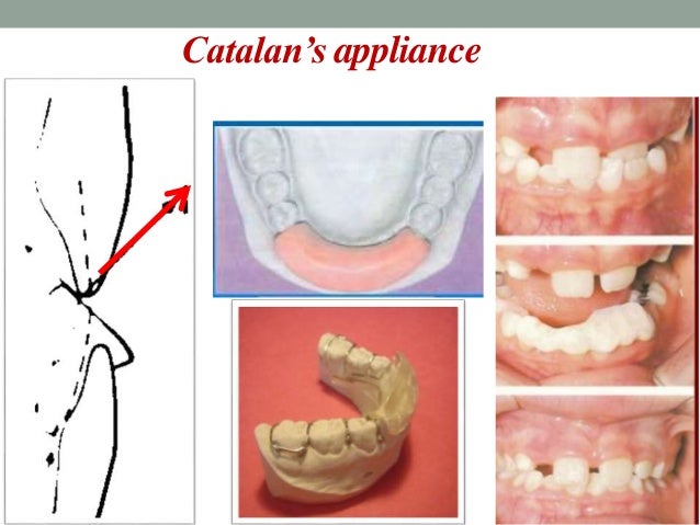 Anterior crossbite