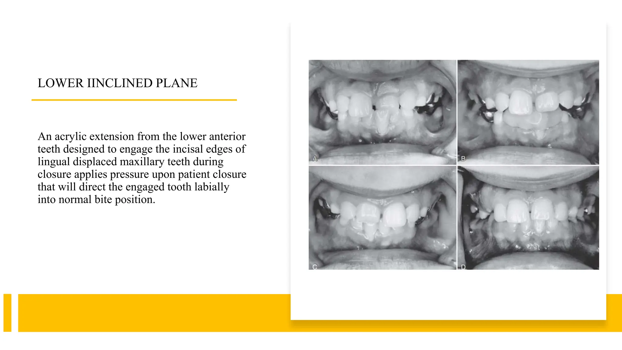 Anterior Crossbite in Primary and Mixed Dentitions.pptx