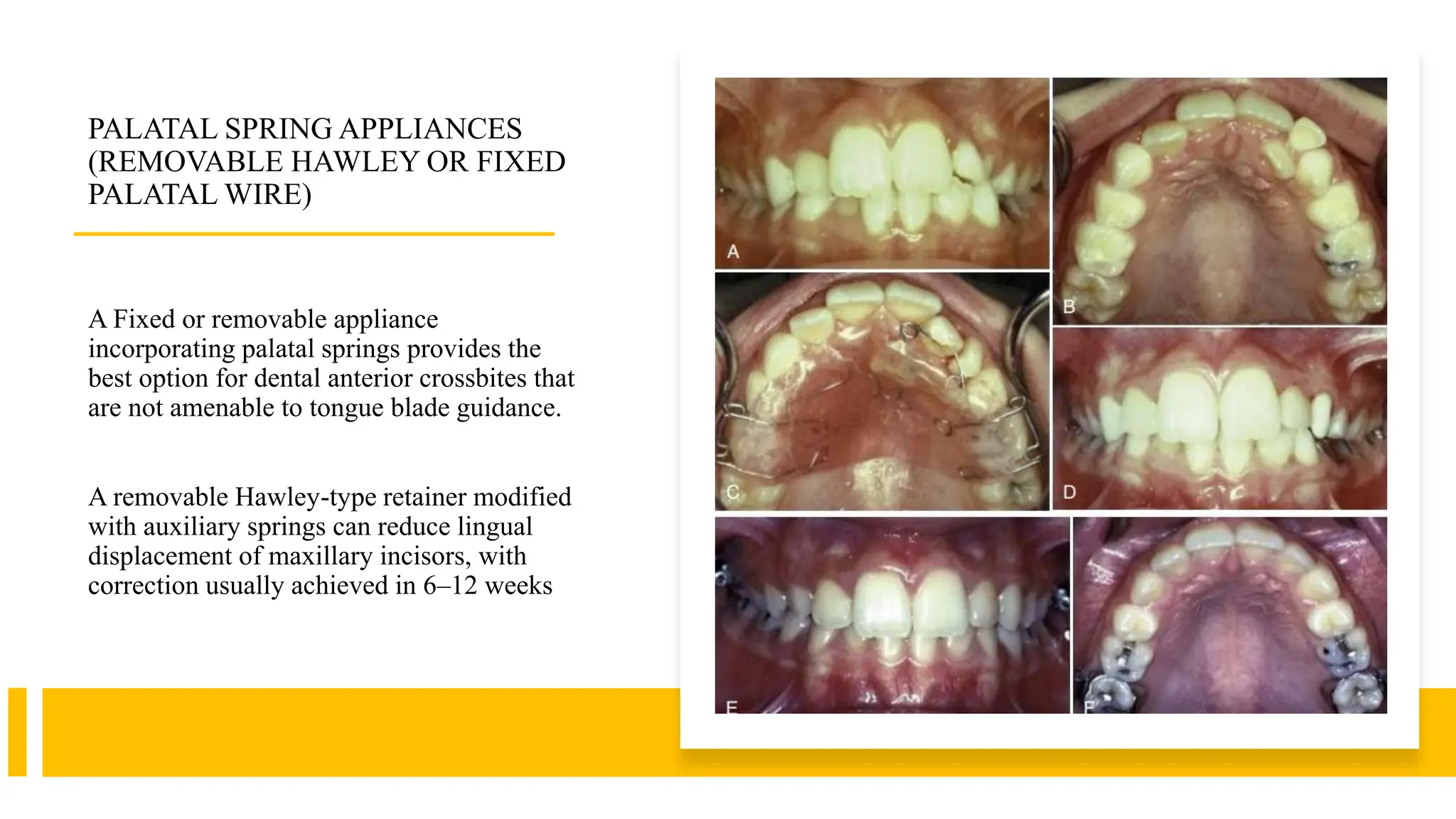 Anterior Crossbite in Primary and Mixed Dentitions.pptx