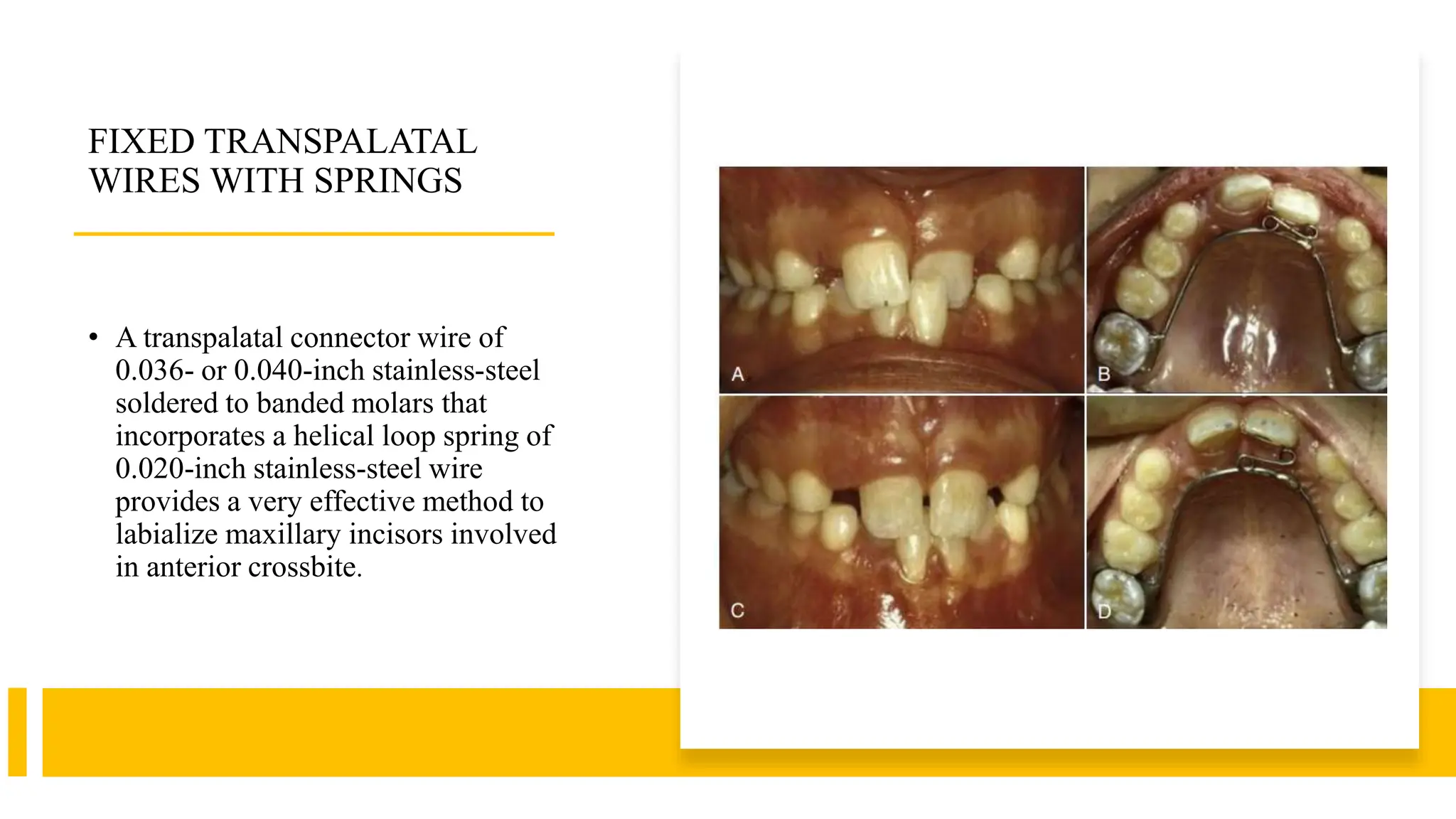 Anterior Crossbite in Primary and Mixed Dentitions.pptx