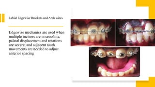 Anterior Crossbite in Primary and Mixed Dentitions.pptx