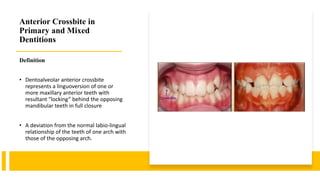 Anterior Crossbite in Primary and Mixed Dentitions.pptx