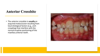 Anterior Crossbite in Primary and Mixed Dentitions.pptx