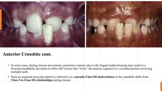 Anterior Crossbite in Primary and Mixed Dentitions.pptx
