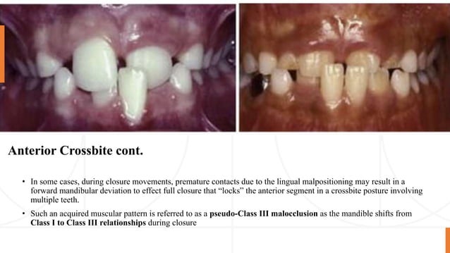 Anterior Crossbite in Primary and Mixed Dentitions.pptx | Oral care ...