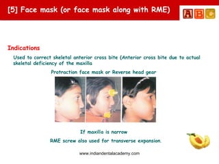 Anterior cross bites in primary& mixed dentition /certified fixed ...