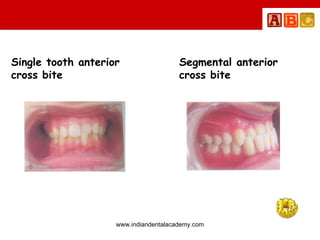 Anterior crossbites in primary & mixed dentition Orthodontic courses ...
