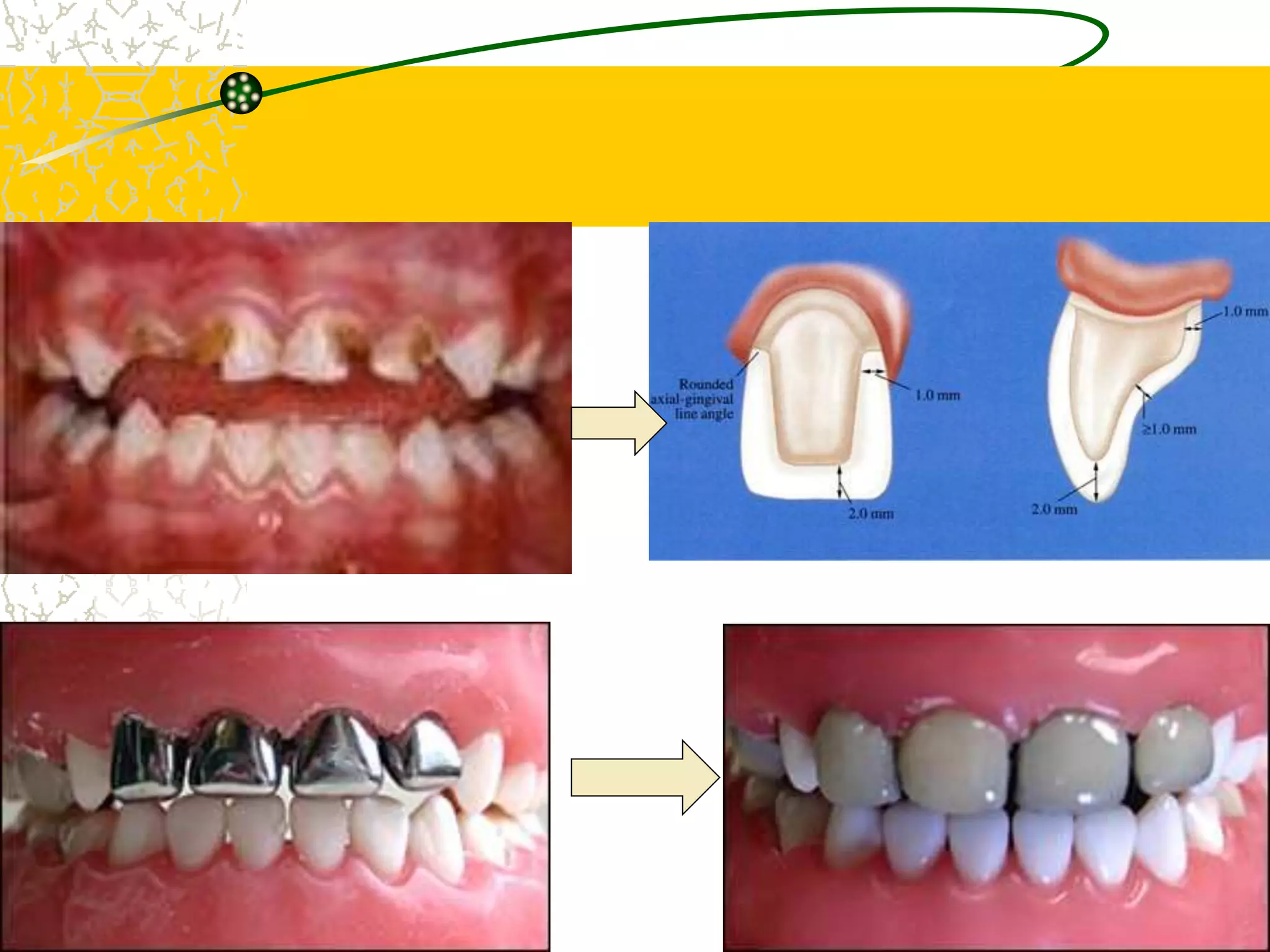 Anterior Crowns.pptx
