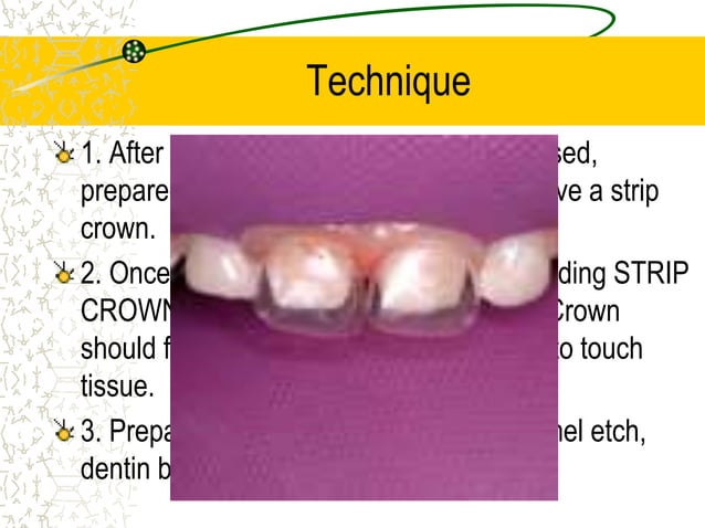 Anterior Crowns.pptx | Dental Health | Diseases and Conditions