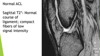 Anterior cruciate injuries and management (2).pptx