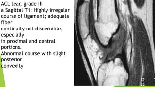 Anterior cruciate injuries and management (2).pptx