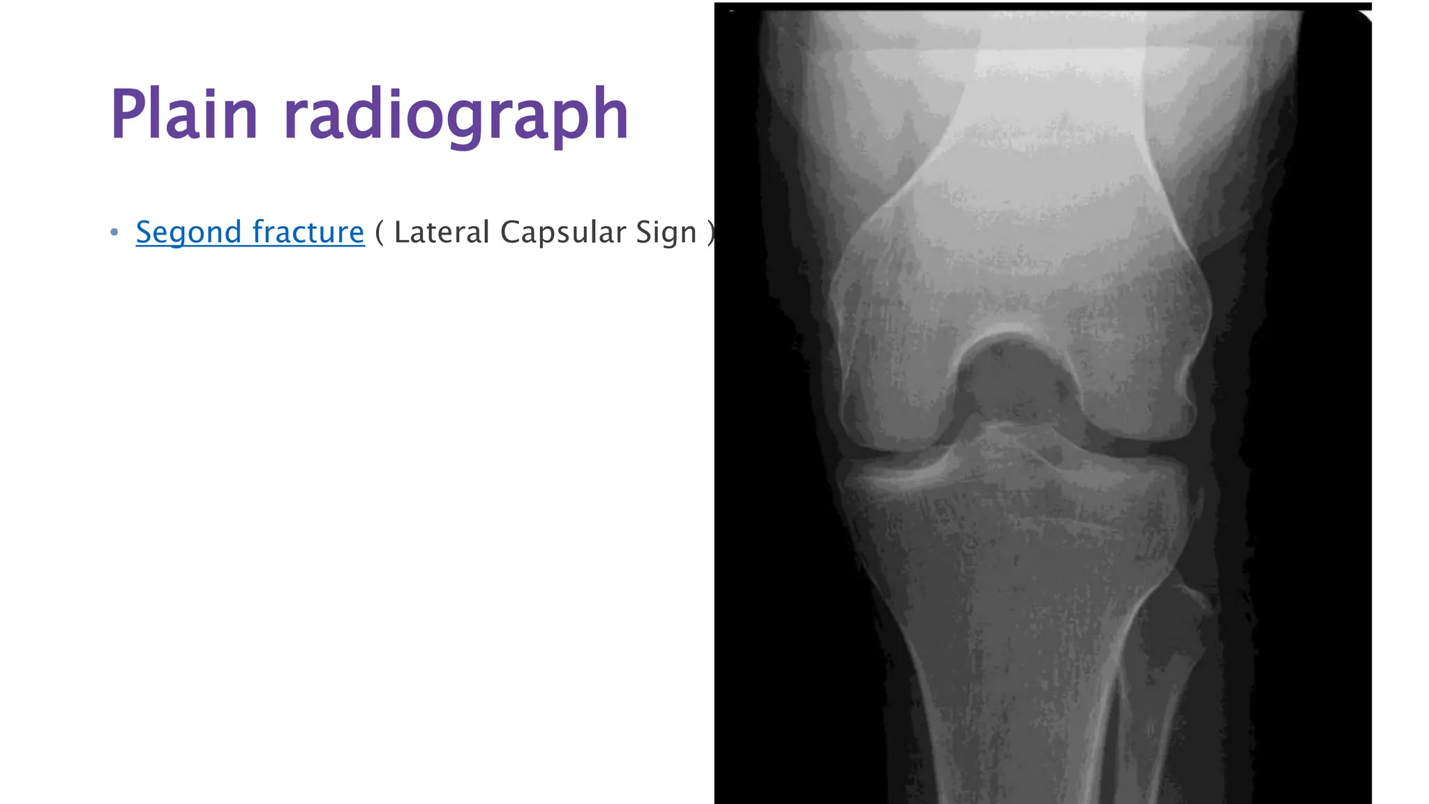 Anterior Cruciate Ligament.pptx