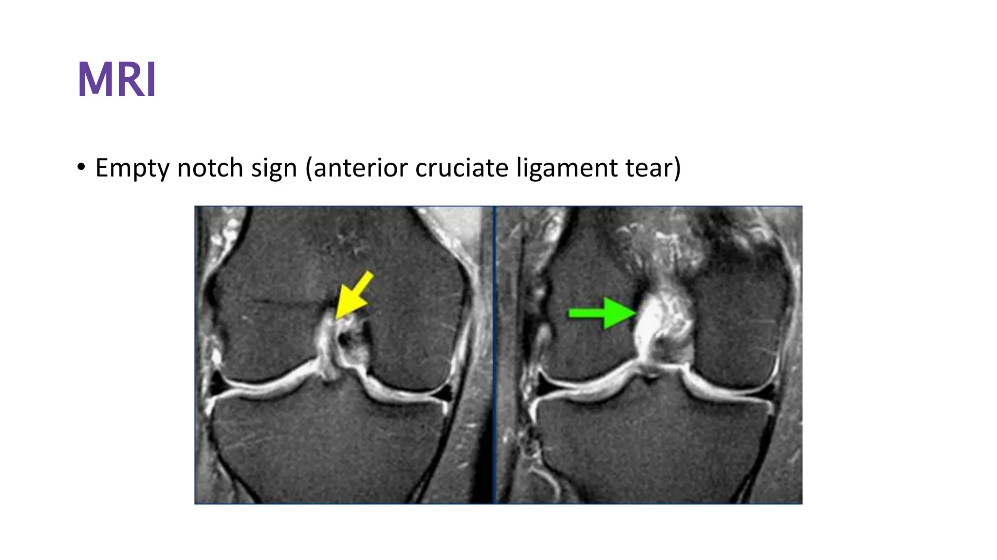 Anterior Cruciate Ligament.pptx
