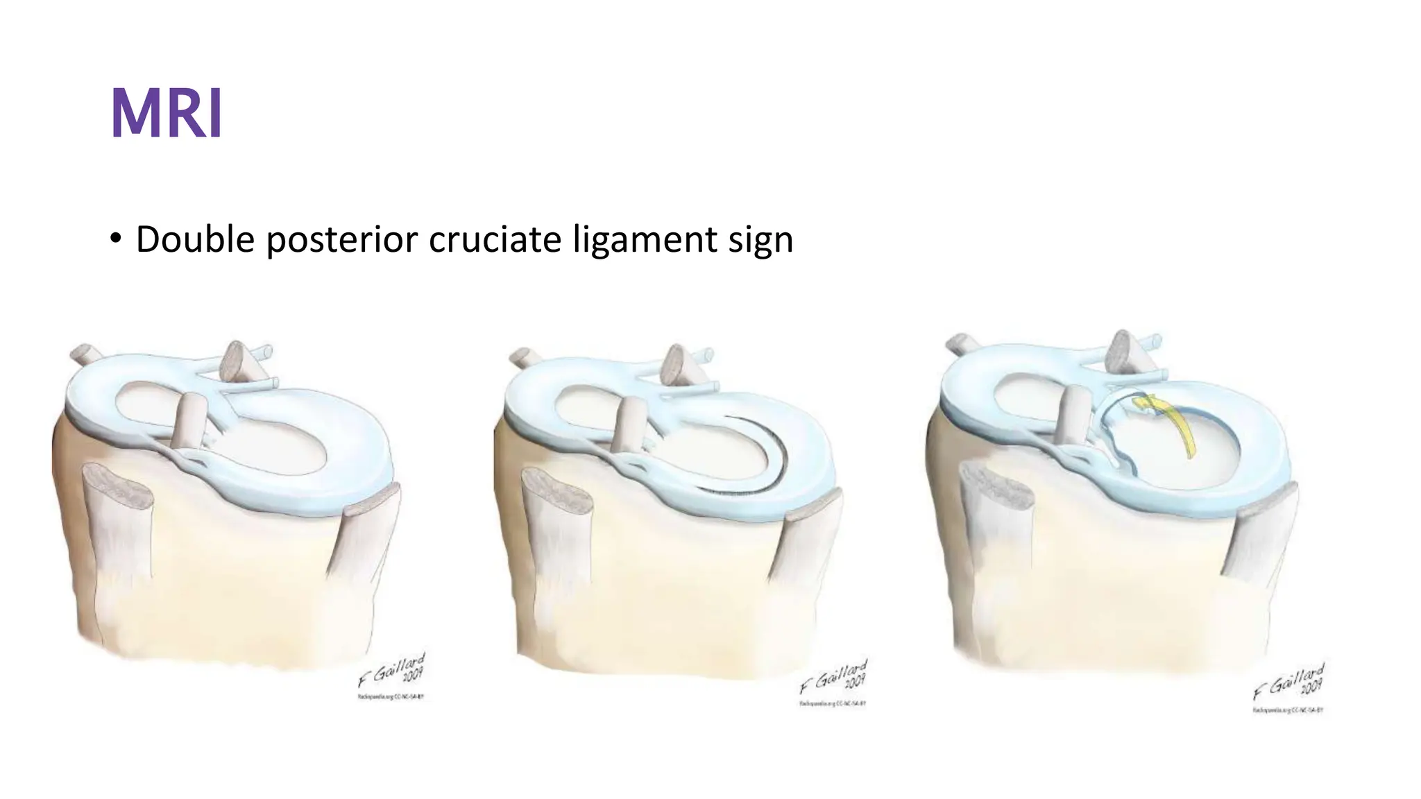 Anterior Cruciate Ligament.pptx
