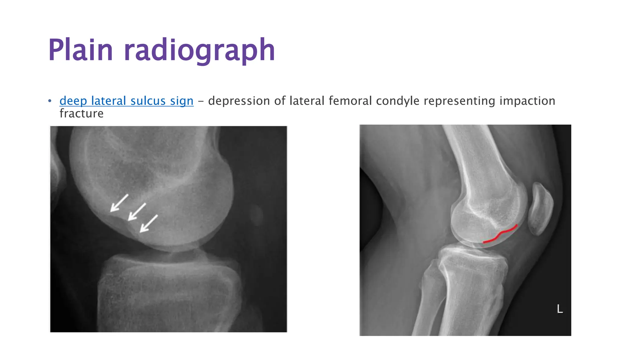 Anterior Cruciate Ligament.pptx