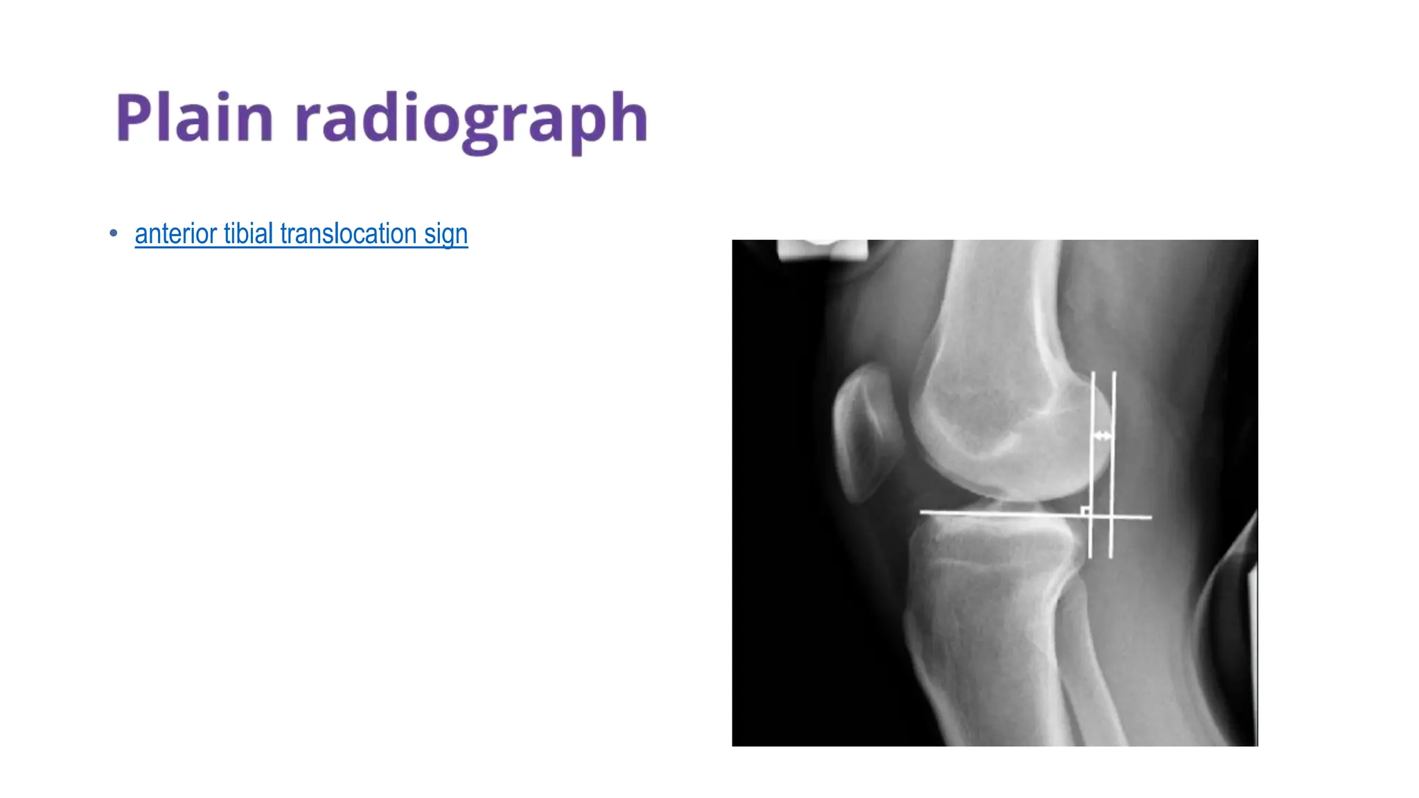 Anterior Cruciate Ligament.pptx