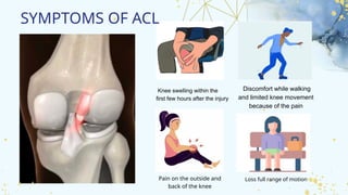Anterior cruciate ligament acl injury.pptx