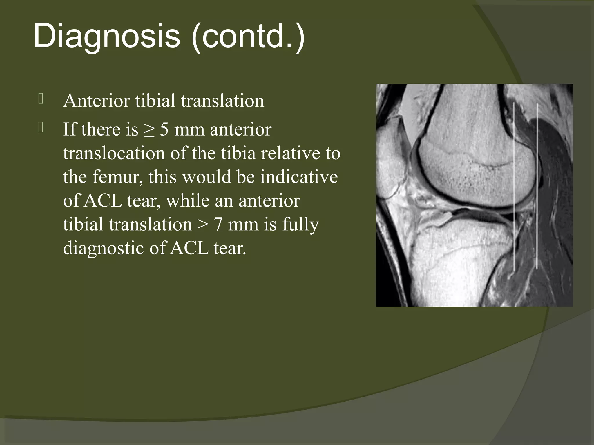 Anterior cruciate ligament injuries micro | PPT