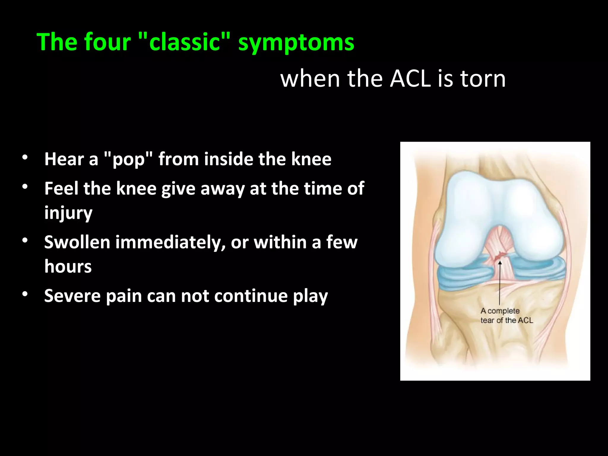 Anterior Cruciate ligament Injury | PPT