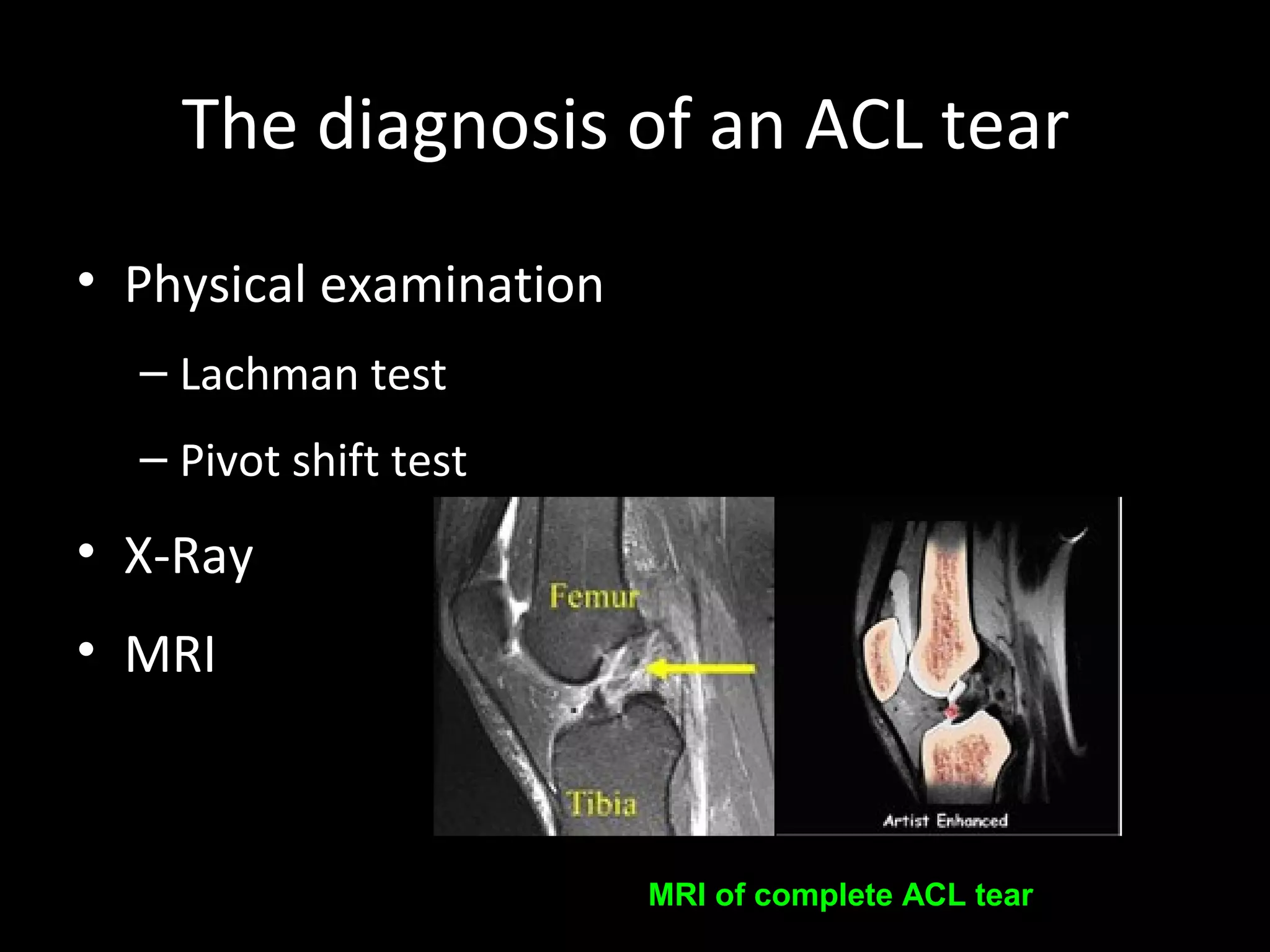 Anterior Cruciate ligament Injury | PPT