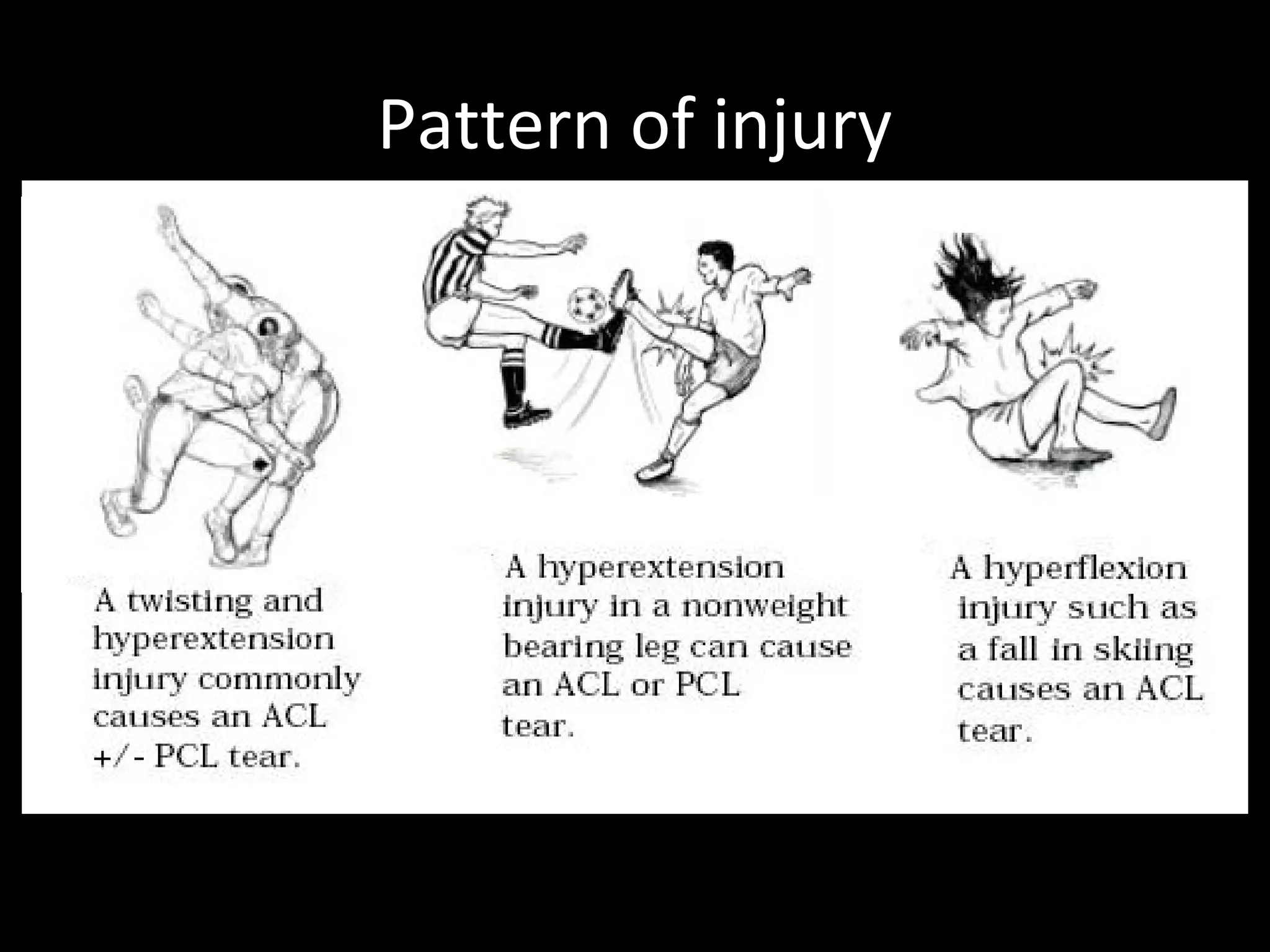 Anterior Cruciate ligament Injury | PPT