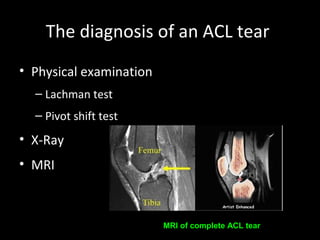 Anterior Cruciate ligament Injury | PPT