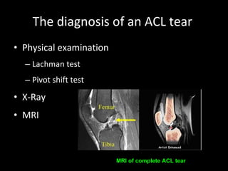 Anterior Cruciate Ligament Injury | PPT