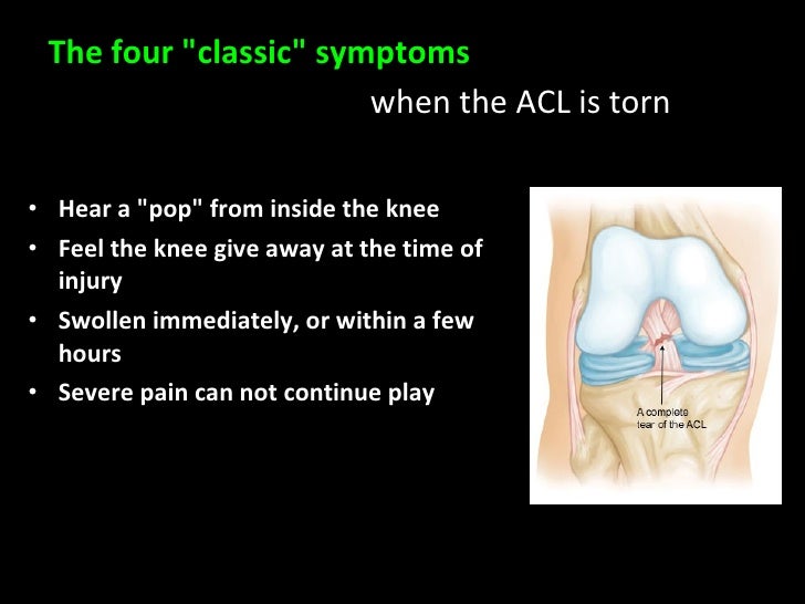 Torn Acl Injury Anterior Cruciate Ligament Tear Symptoms