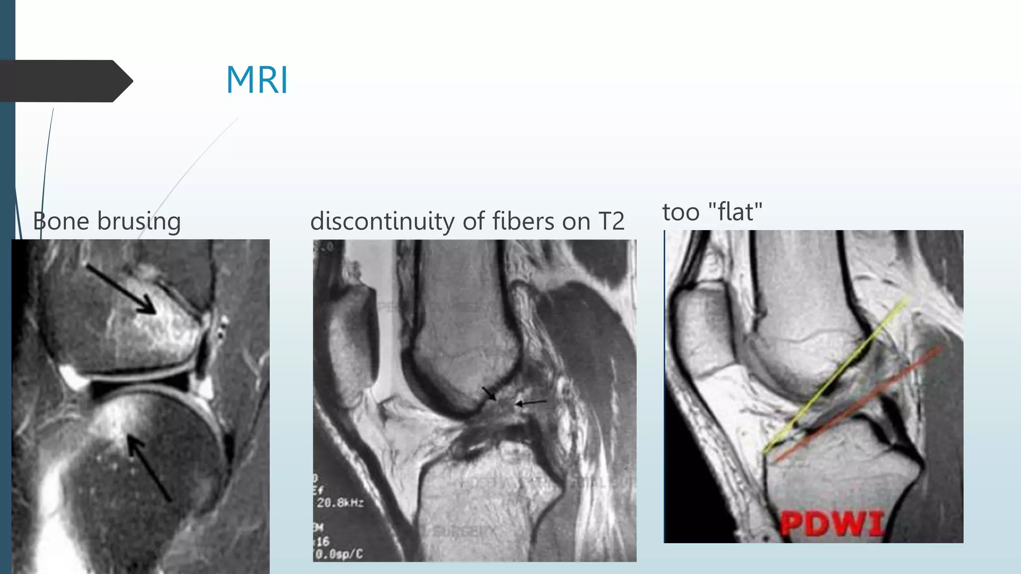 Anterior cruciate ligament injury.pptx
