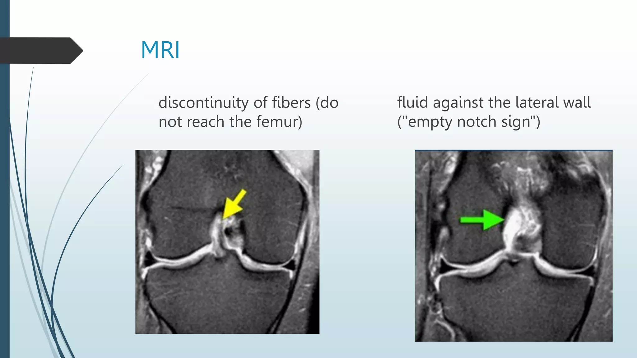 Anterior cruciate ligament injury.pptx