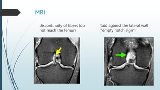 Anterior cruciate ligament injury.pptx
