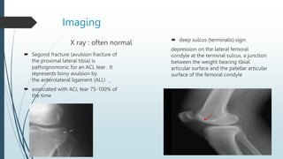 Anterior cruciate ligament injury.pptx