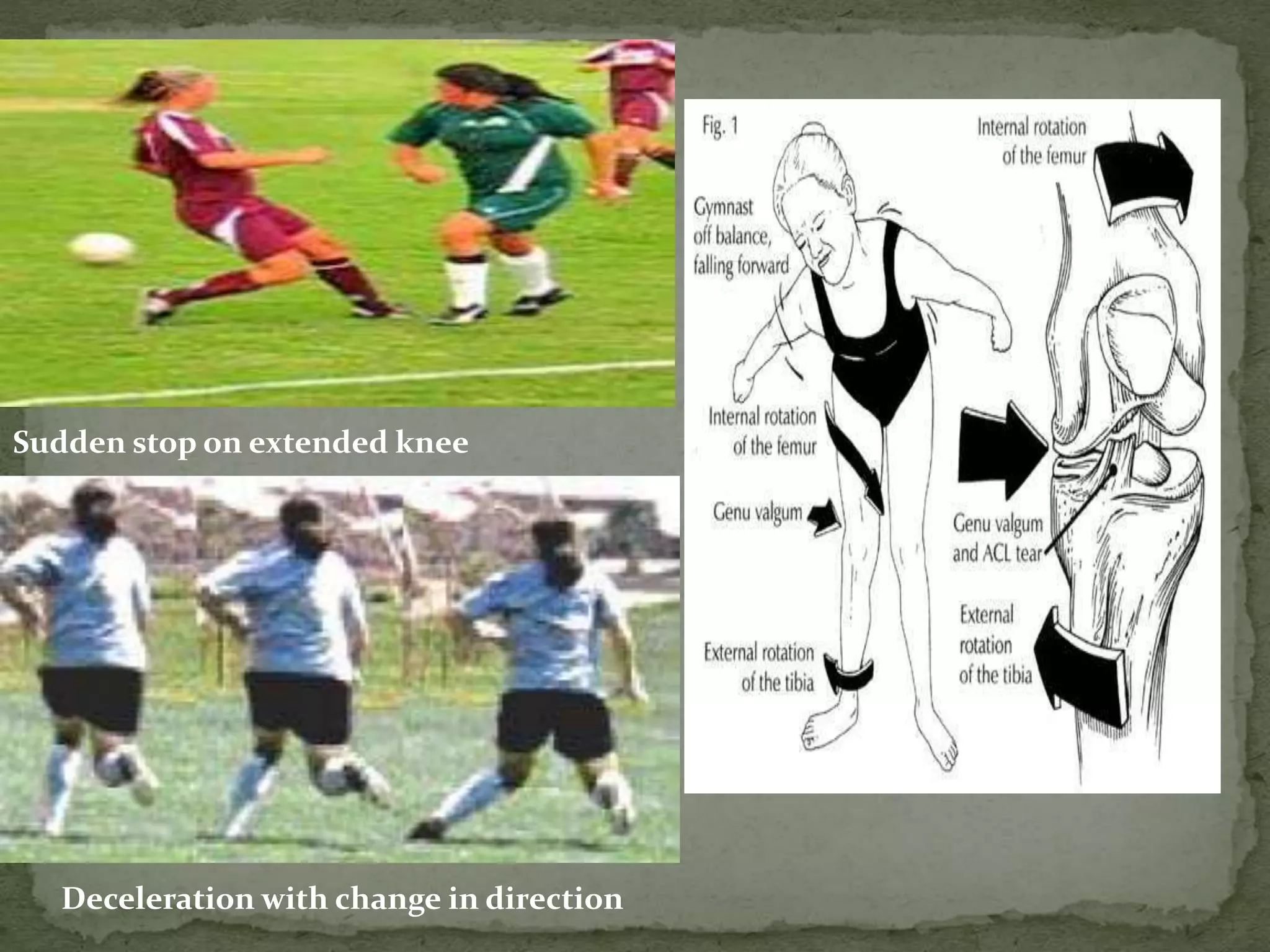 Anterior cruciate ligament reconstruction, rehabilitation, and.pptx