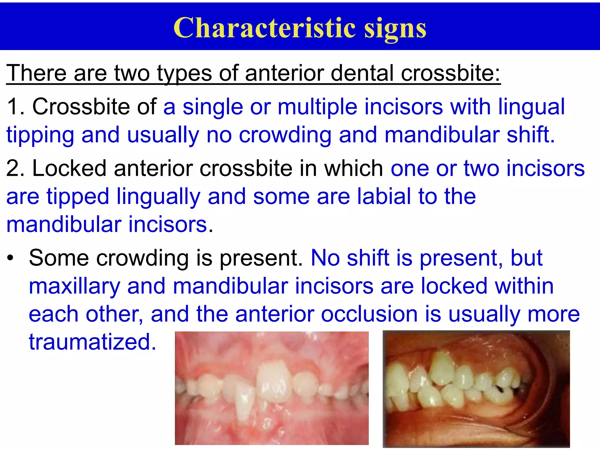 Anterior dental crossbite and class iii malocclusion1 | PPTX