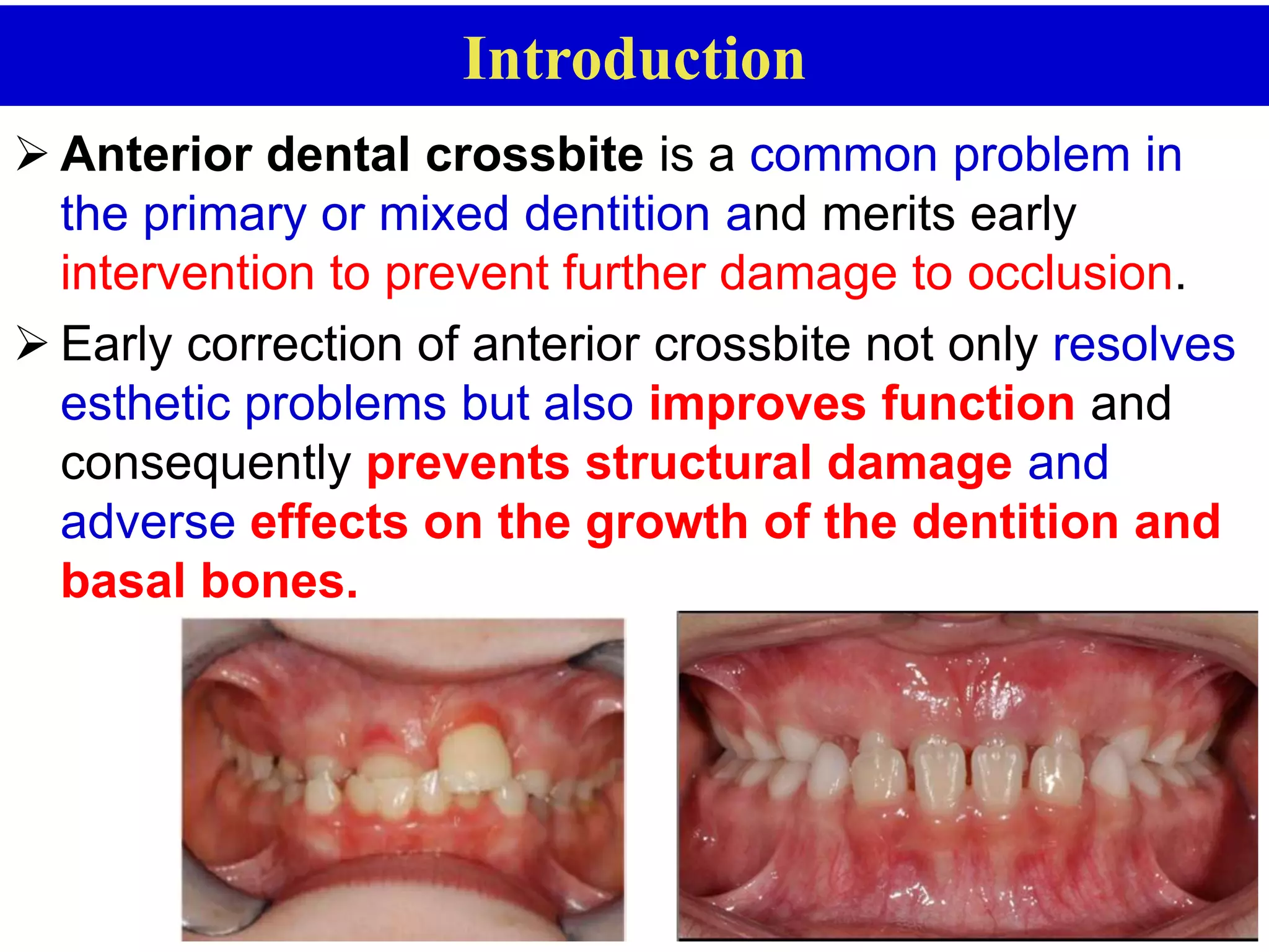 Anterior dental crossbite and class iii malocclusion1 | PPTX