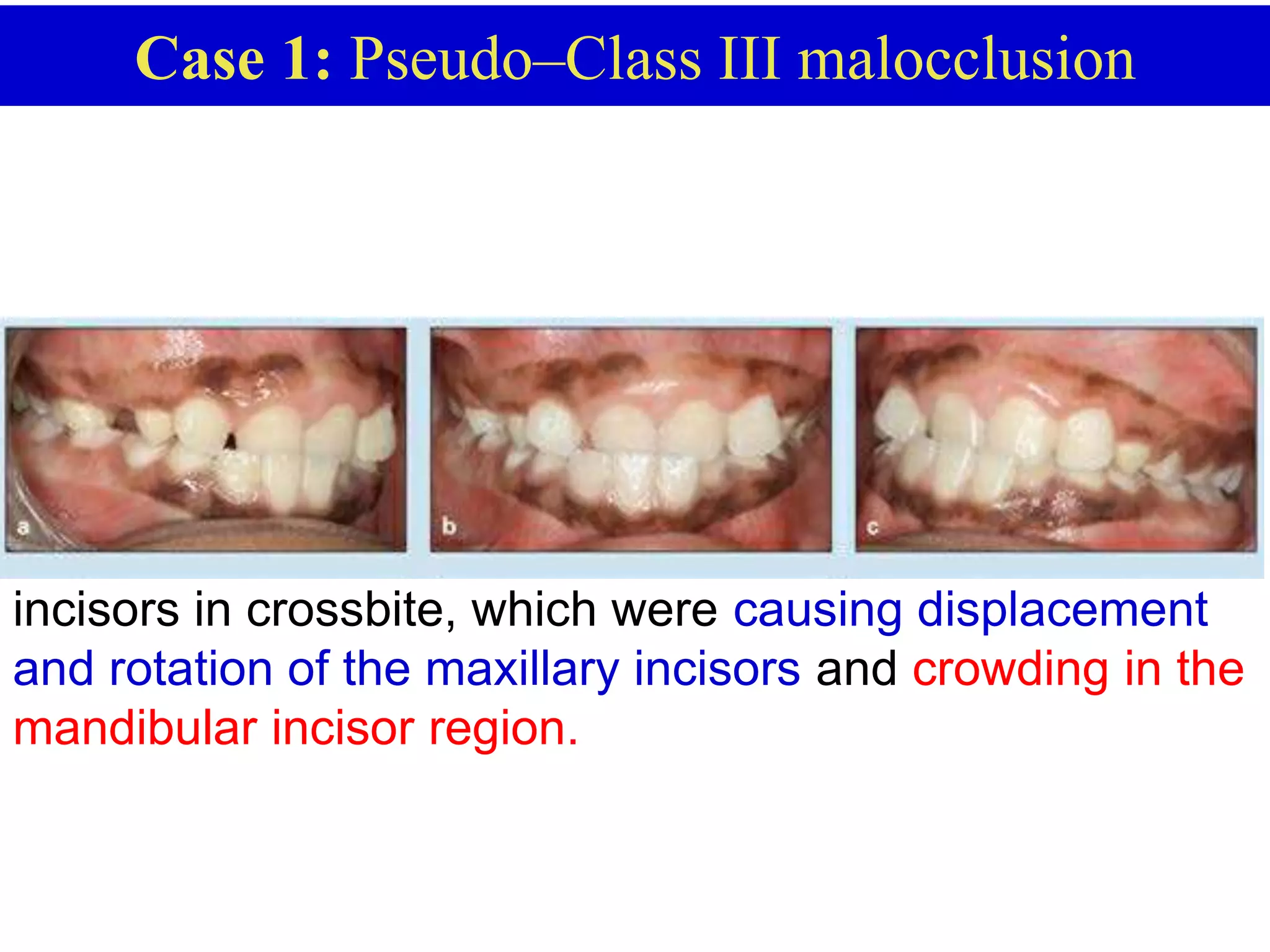 Anterior dental crossbite and class iii malocclusion1 | PPTX