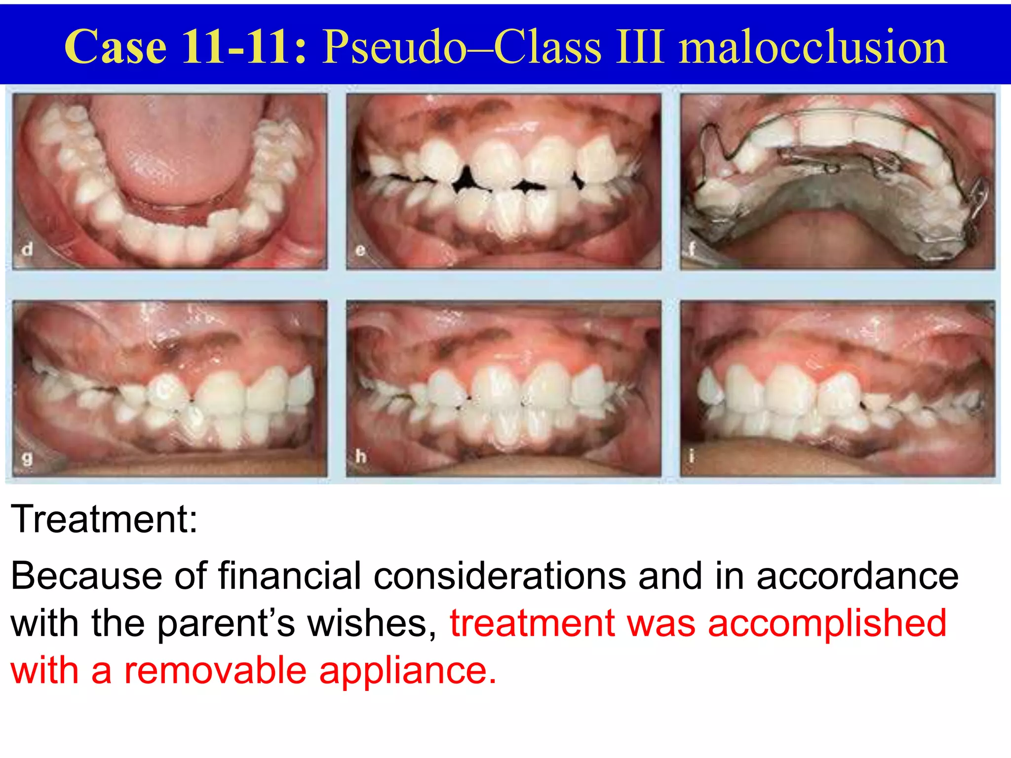 Anterior dental crossbite and class iii malocclusion1 | PPTX