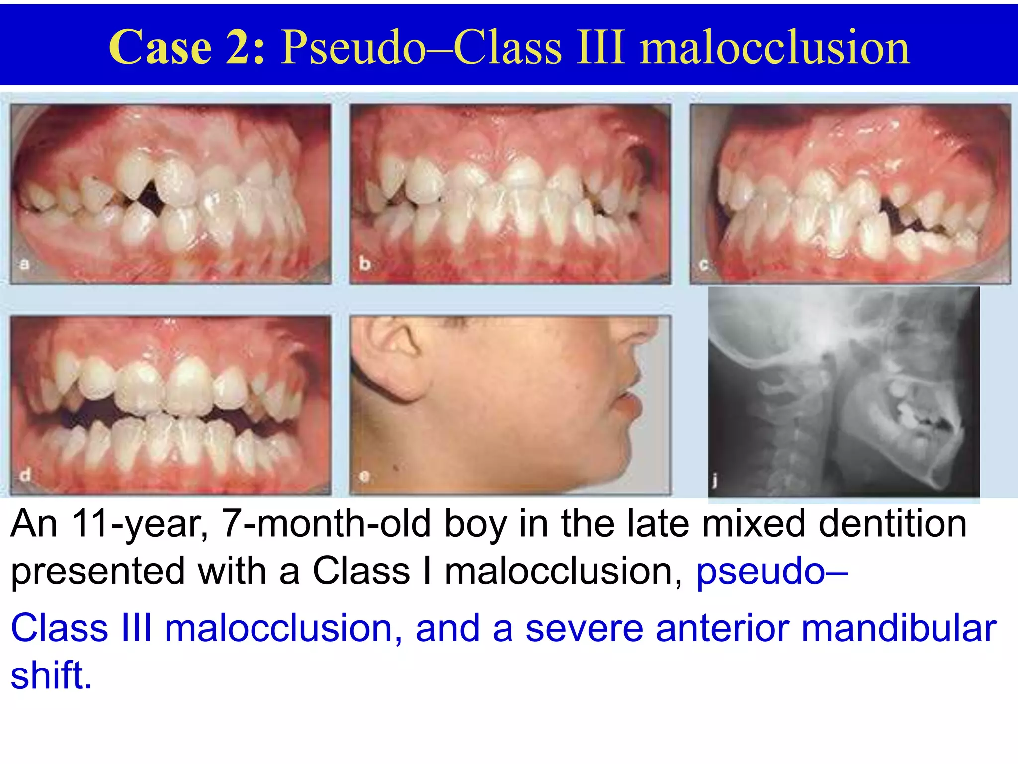 Anterior dental crossbite and class iii malocclusion1 | PPTX
