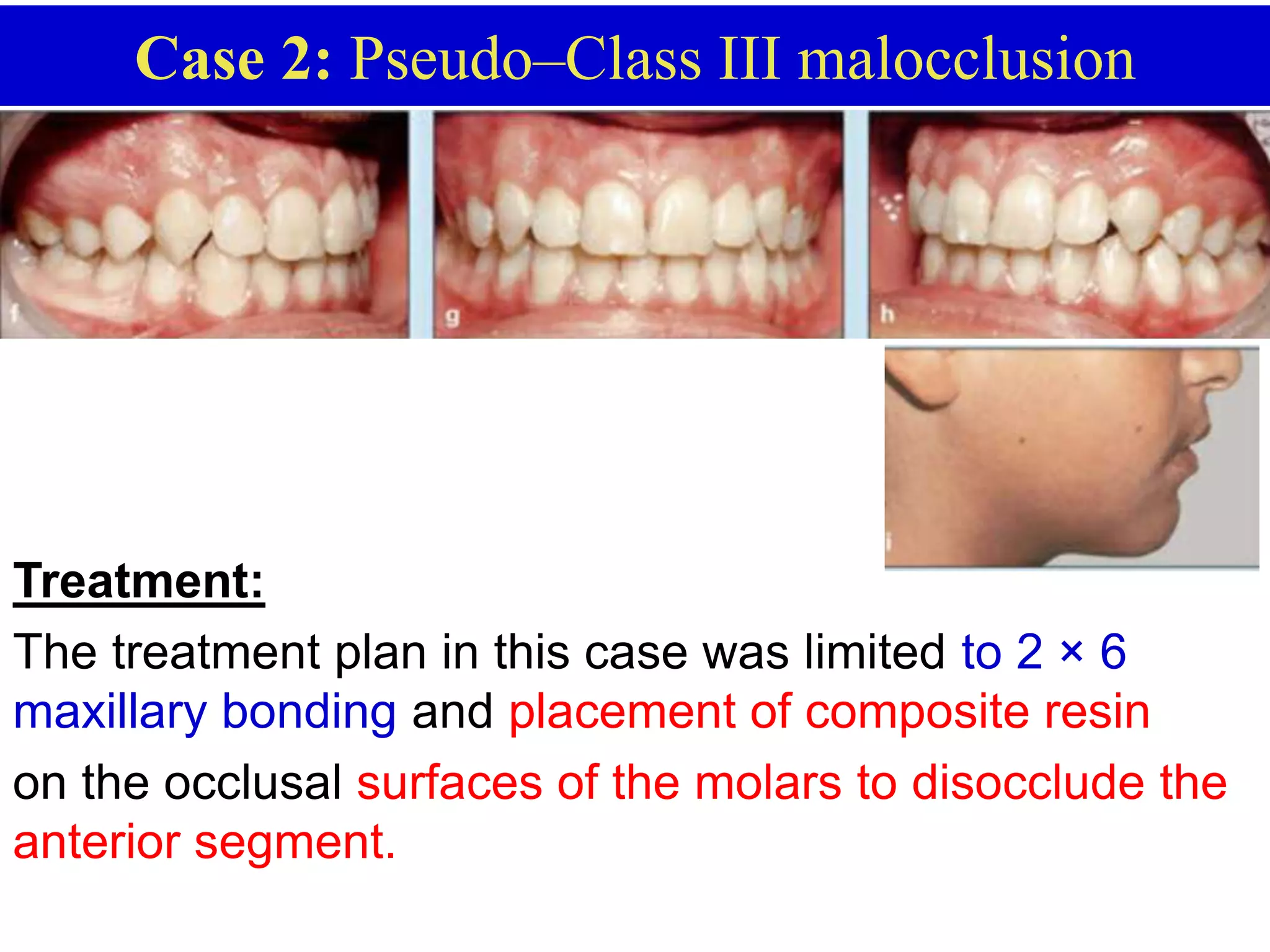 Anterior dental crossbite and class iii malocclusion1 | PPTX