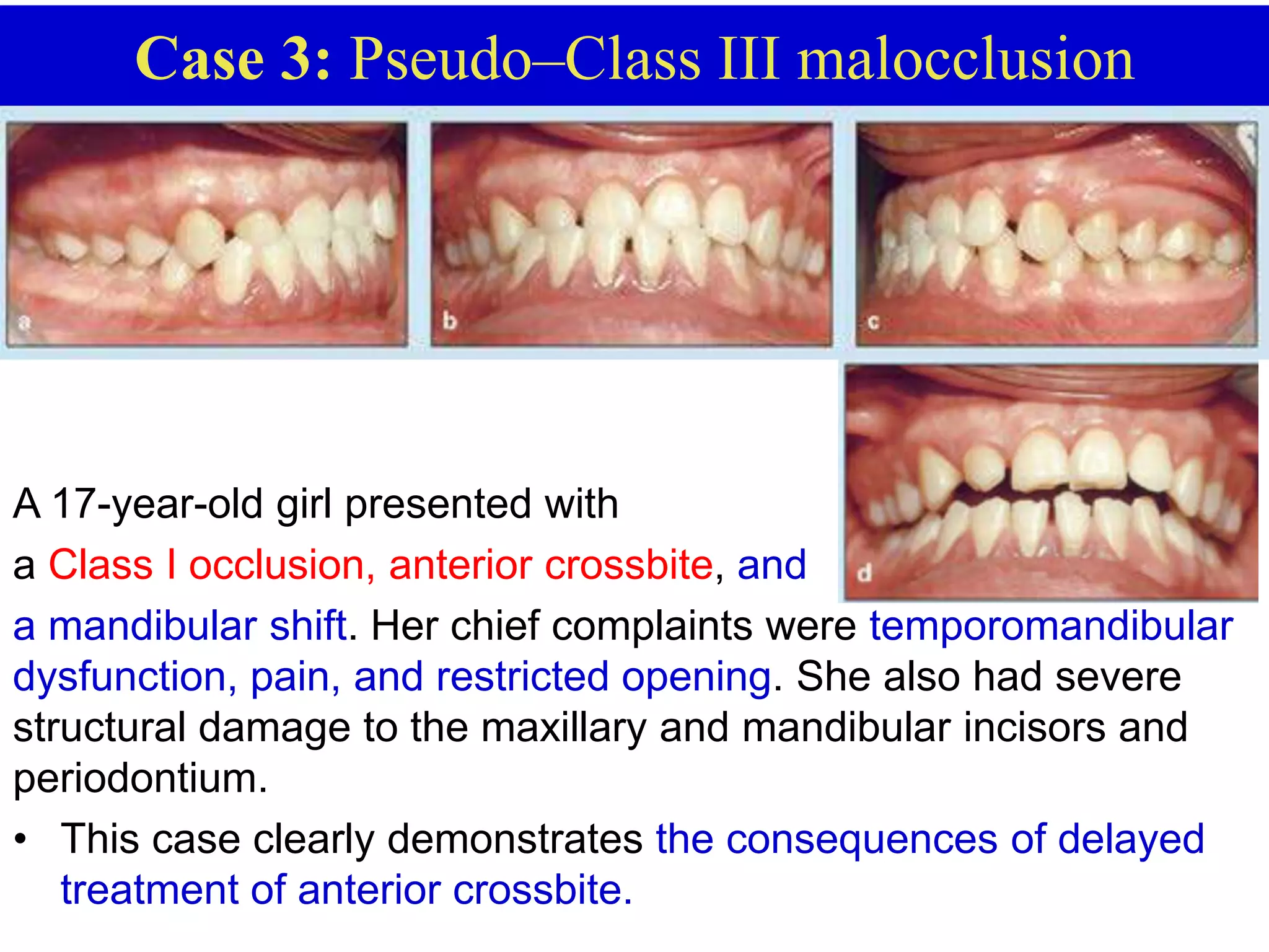 Anterior dental crossbite and class iii malocclusion1 | PPTX